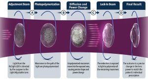 RXSight Adjustable Lens - denvereyesurgeons